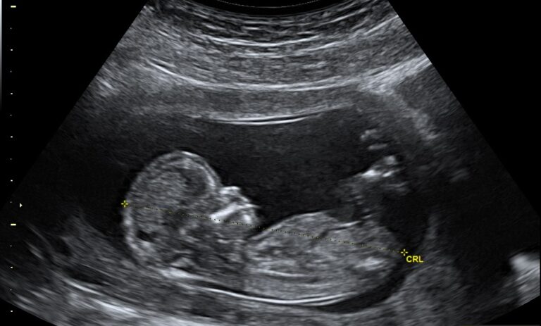 Early Reassurance Scan From 10 weeks Luton & Dunstable